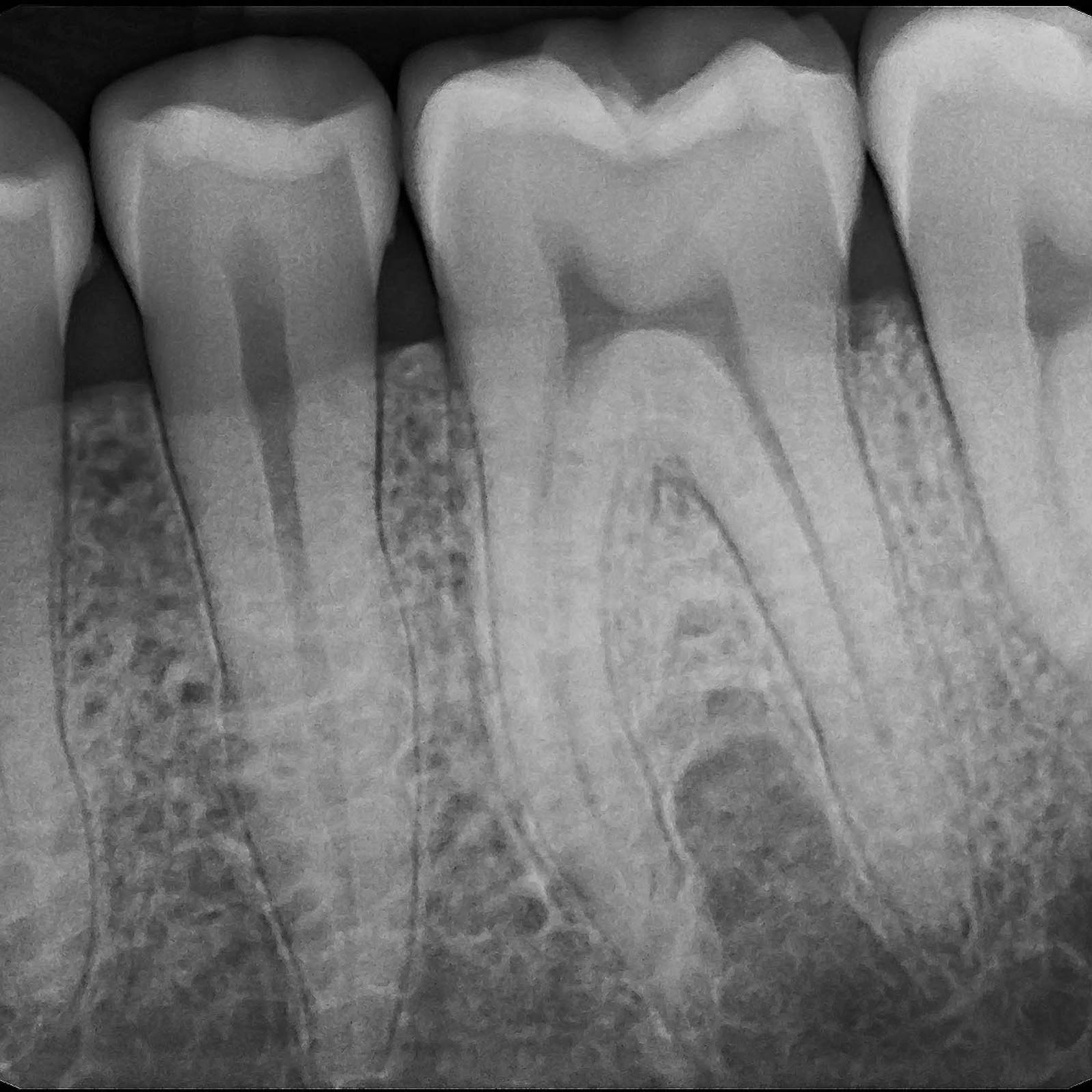 SOTA Imaging Clio Prime HD Intraoral Digital X-Ray Sensor | JMU Dental